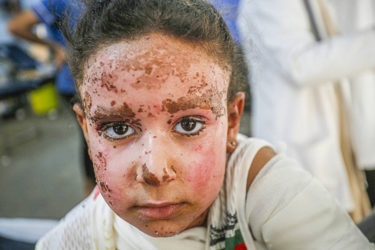 Palestinian girl injured in Israeli attack loses her entire family in ...