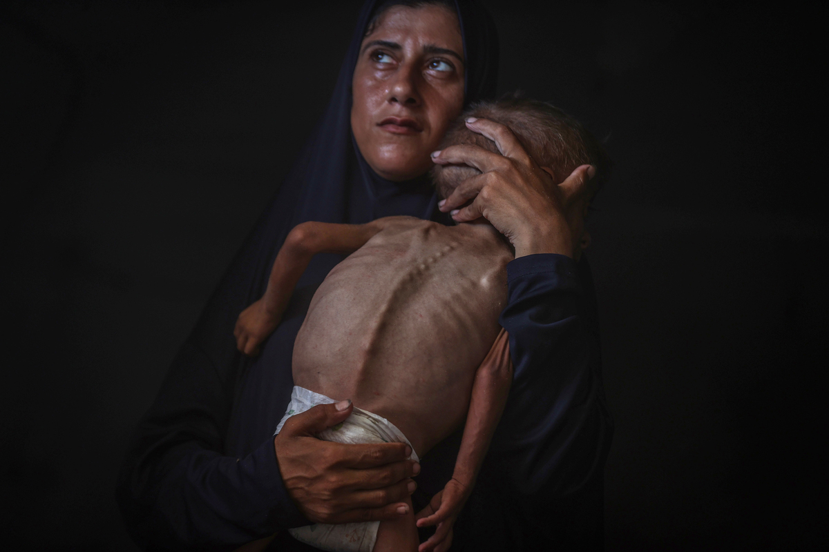 Palestinian baby in Gaza suffering from malnutrition at risk of death ...