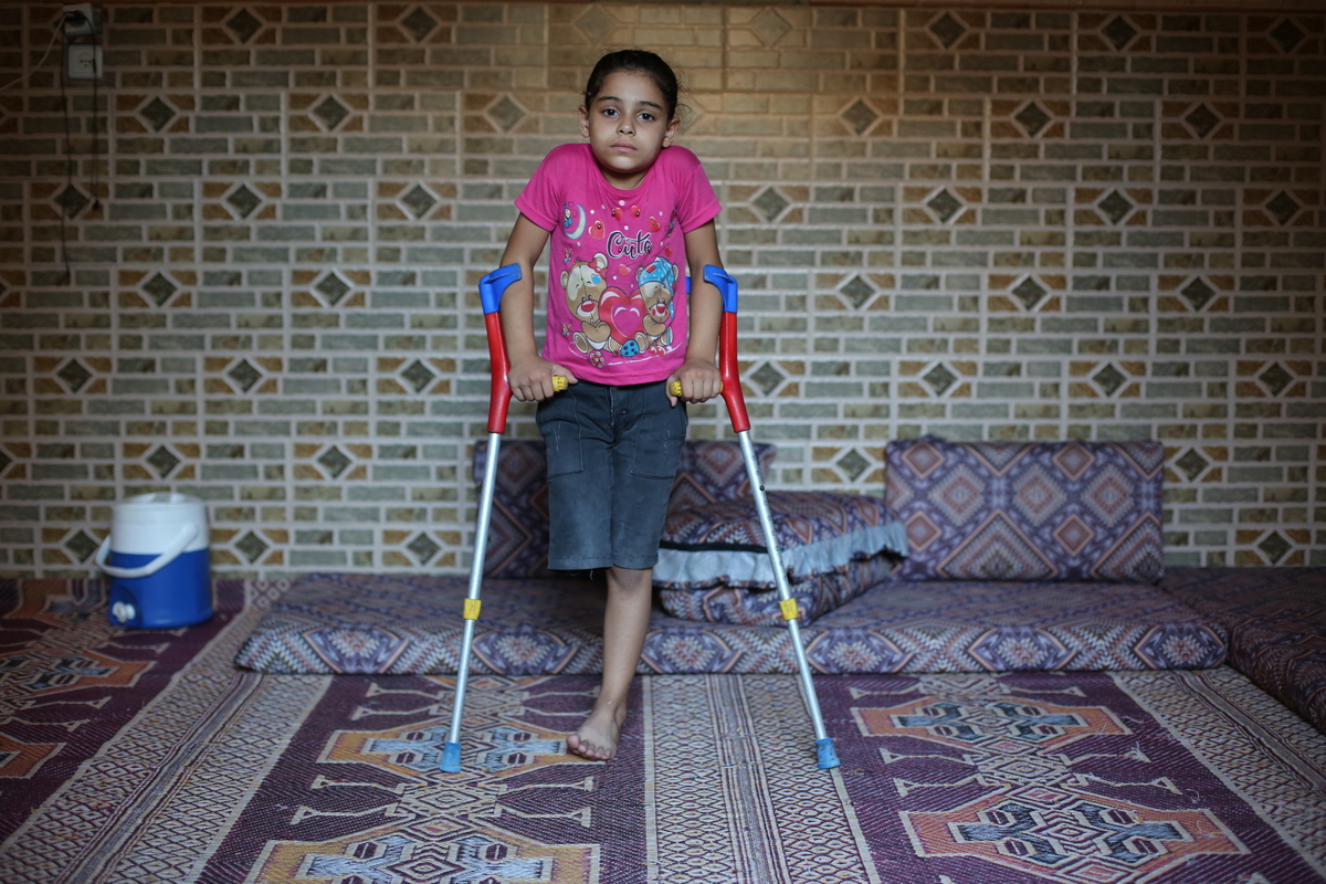 9-year-old Gaza child awaiting prosthetics after losing one leg in ...