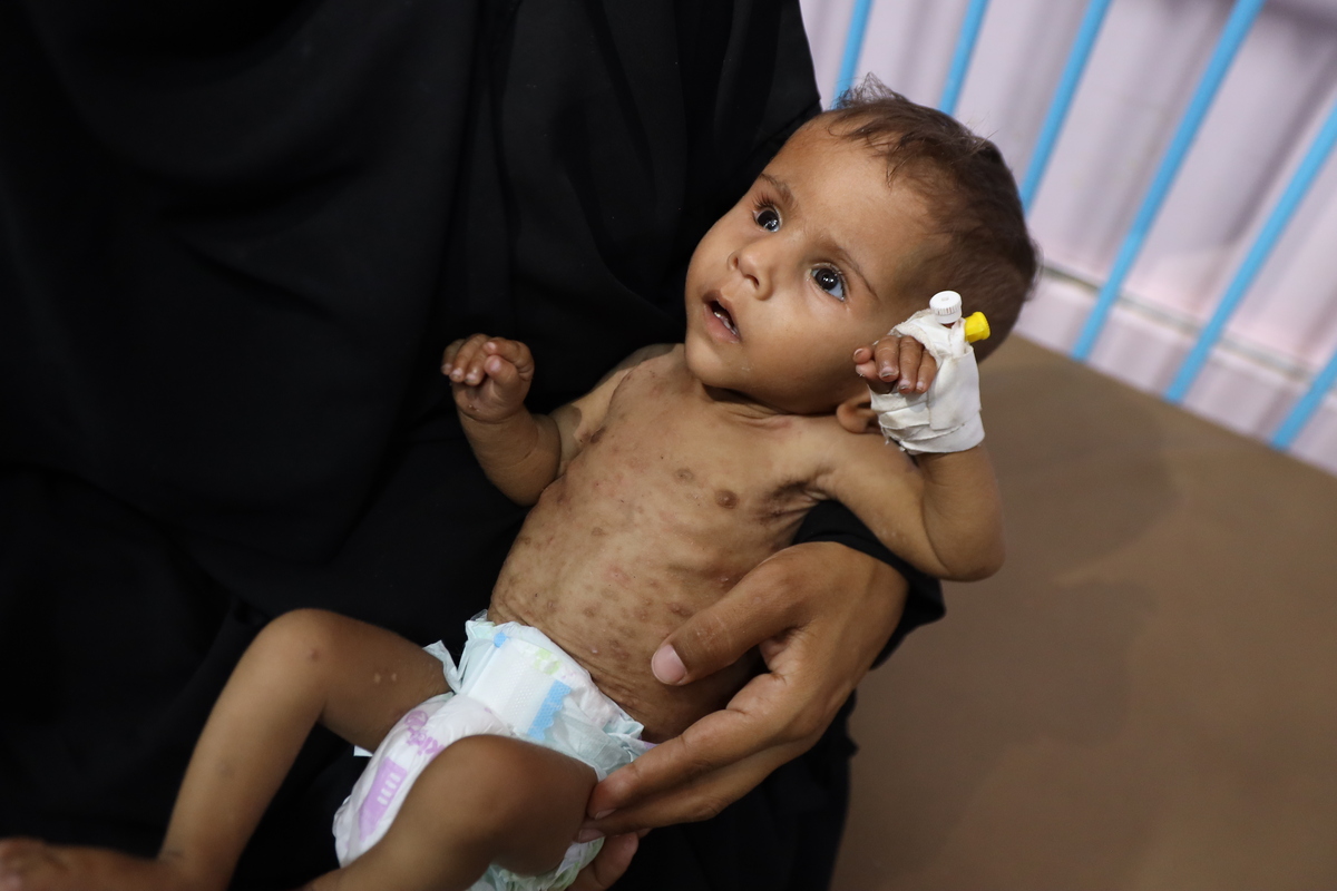 Palestinian baby starved by Israel fighting for his life in Gaza ...